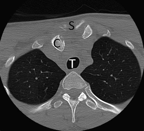 Sports Injury Bulletin Diagnose And Treat Sternoclavicular Joint