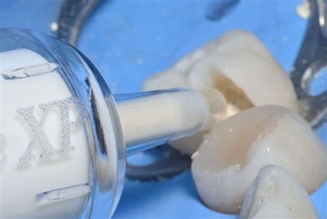 Direct Pulp Capping With Biobulk Technique