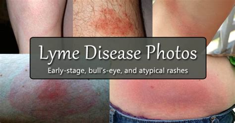 Lyme Disease Rash Photos Early Stage Bulls Eye And Atypical Rashes