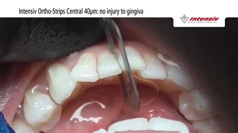 Perform IPR With Intensiv Swingle TrioClear