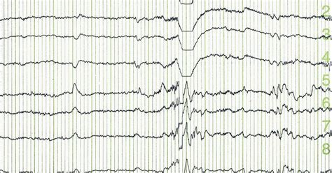 Understanding Your Eeg Results Normal And Abnormal Eegs Understanding Your Eeg Results Normal And Abnormal Eegs