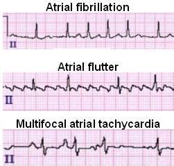 Atrial Flutter Topic Review Learn The Heart