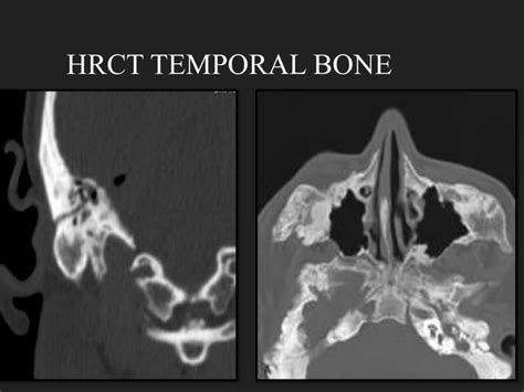 Hrct Chesttemporal Bone Protocolpptx