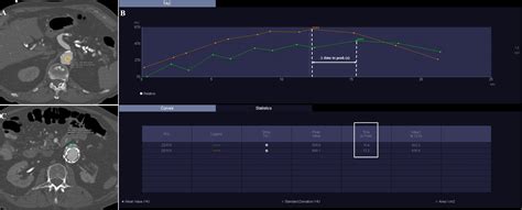 Time Resolved Dynamic Computed Tomography Angiography For Characterization Of Aortic Endoleaks