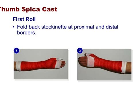 Casting Splinting Ppt