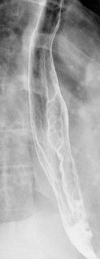 Pharynx And Esophagus Radiology Key Pharynx And Esophagus Radiology Key