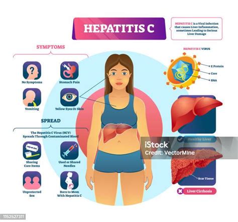 C 형 간염 벡터 일러스트입니다 표시 된 바이러스 성 감염 설명 체계 간염에 대한 스톡 벡터 아트 및 기타 이미지 간염