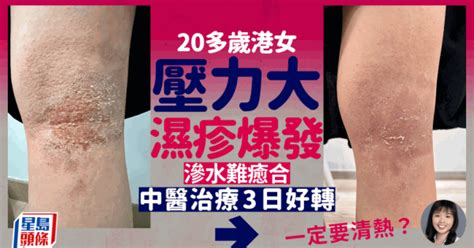 20多歲港女自小患濕疹 壓力大濕疹爆發滲水 中醫治療3日好轉 防復發要清熱？ 星島日報
