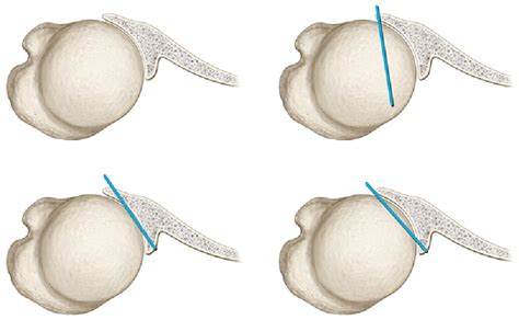 Figure 2 From Addressing Glenoid Erosion In Anatomic Total Shoulder Arthroplasty Semantic Scholar