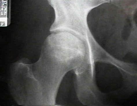 Avascular Necrosis Of Femoral Head Wheeless Textbook Of Orthopaedics