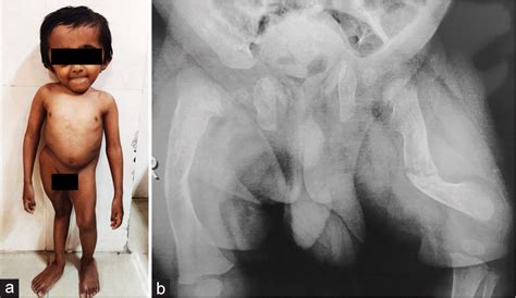 Osteogenesis Imperfecta Ultralyd