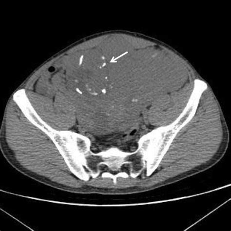 Pelvic Enhanced Computed Tomography That Shows A 10×9×7 Cm Mass With Download Scientific