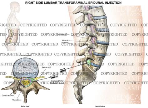L5 S1 Right Side Female Lumbar Transforaminal Epidural Injection