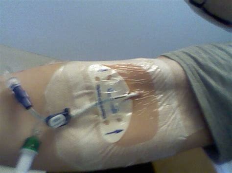 This Is My First Picc Line I Had Two If Your Skin Gets Irritated Easily As Mine Did Make