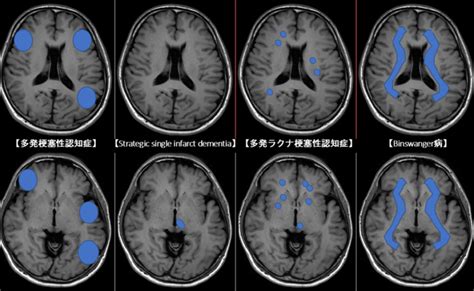 Vascular Dementia