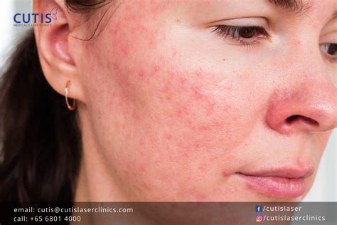 Combat Facial Bumps With A Chemical Peel In Singapore