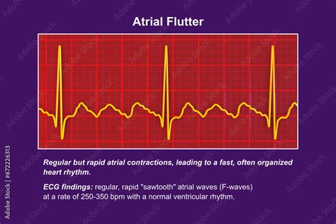 Ecg In Atrial Flutter An Abnormal Heart Rhythm Characterized By Rapid