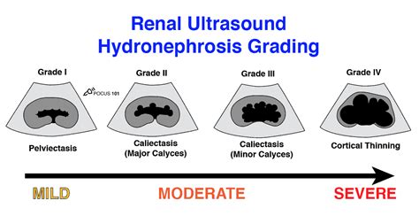 Grading System Hydronephrosis In Adults