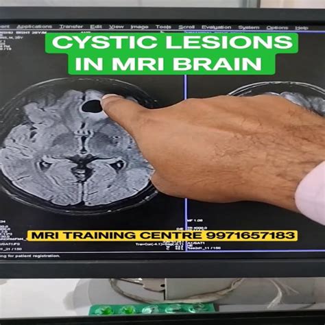 Brain Tumor Detection Object Detection Dataset V2 Mahitha By Brain Tumor