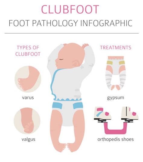 290개 이상의 내반족 이미지 스톡 사진 그림 및 Royalty Free 이미지 Istock