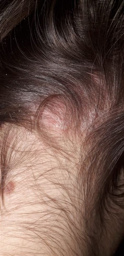 Dovobet For Scalp Psoriasis R Psoriasis