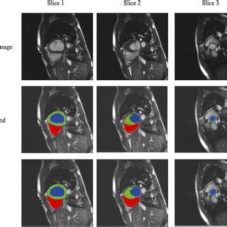 Segmentation Results From Analysis Of The Three Slice Heart Samples