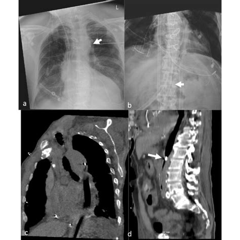 Intra Aortic Balloon Pump Iabp Chest Ap Radiograph A Demonstrating