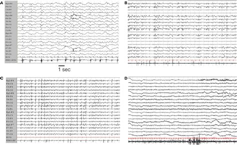 Eeg Evolution In Case 1 A Eeg During The Initial Hours Of Status