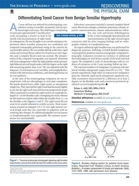 Differentiating Tonsil Cancer From Benign Tonsillar Hypertrophy Pdf