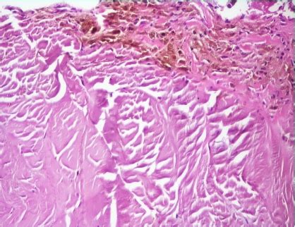 Ochronosis Histology