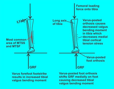 Effect Of Varus Forefoot Foot Kevin A Kirby Dpm
