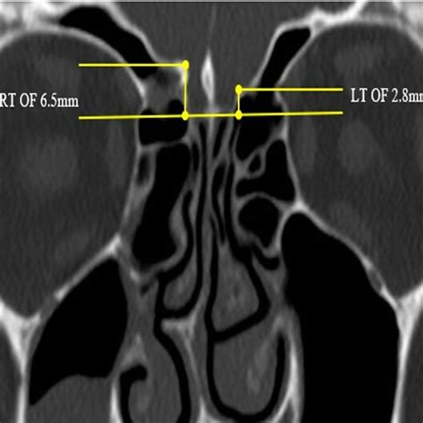 Keros Classification According To Gender Among Different Studies N