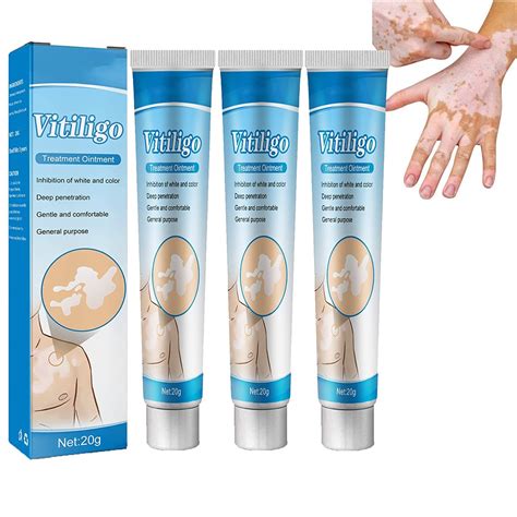 Vitiligo Treatment Cream White Spot Cream Vitiligo Cream Treatment