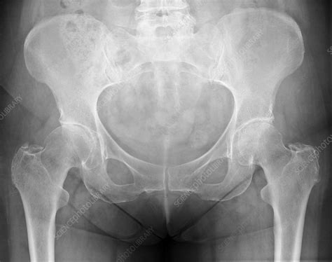 Osteoarthritis Of The Hip X Ray Stock Image M1100696 Science Photo Library