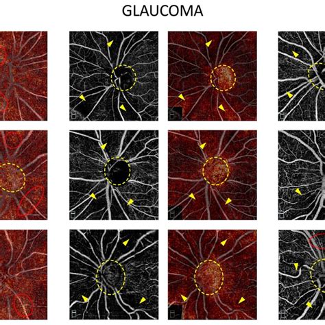 Examples Of Radial Peripapillary Capillaries Plexus Rpc Attribution
