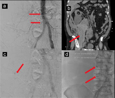 Psoas Hematoma