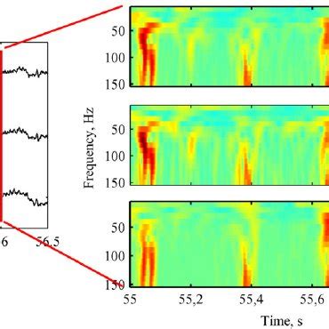 An Example Of The ECoG Signal Registered By Three Electrodes And Its Download Scientific