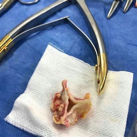 Aortic Valve Calcification Is A Condition In Which Calcium Deposits