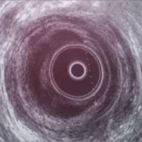 Endoanal Ultrasound Finding Consistent With Defect