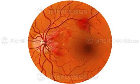 Neovascularization Disc And Elsewhere Stock Eye Images