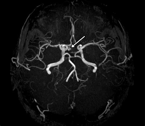 Aneurysm Arrow Of The Cavernous Portion Of The Right Internal Carotid Download Scientific