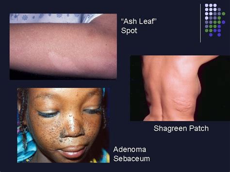 Neurocutaneous Syndromes Neurofibromatosis Tuberous Sclerosis Sturge Weber Neurocutaneous