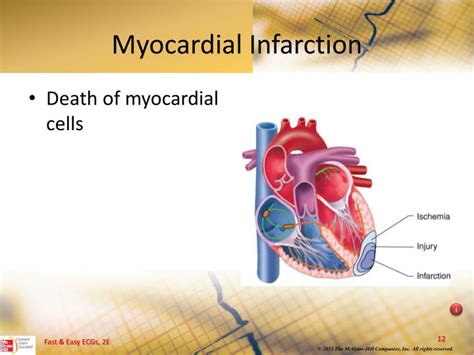 Ppt Myocardial Ischemia Injury And Infarction Powerpoint Hot Sex Picture