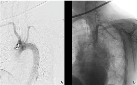 Intraoperative Fluoroscopic Images Demonstrating A A Patent Aortic