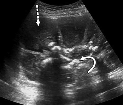 Xanthogranulomatous Mastitis