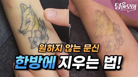 1회 시술로 이정도로 지워진다고 빠르게 지워지는 위드윈피부과 문신제거 노하우 공개 Youtube