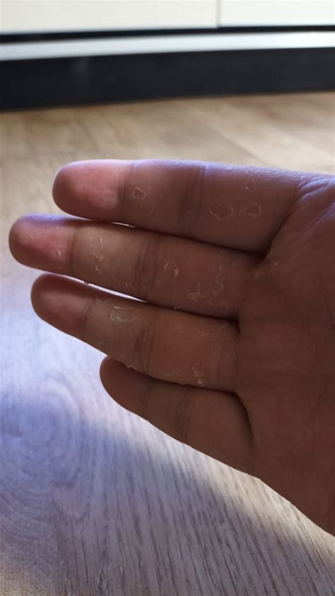 손에 피부 영양실조 지식in