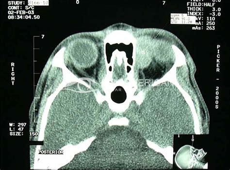 Granulocytic Sarcoma Sociedad Panamericana De Oncología Ocular Paoos