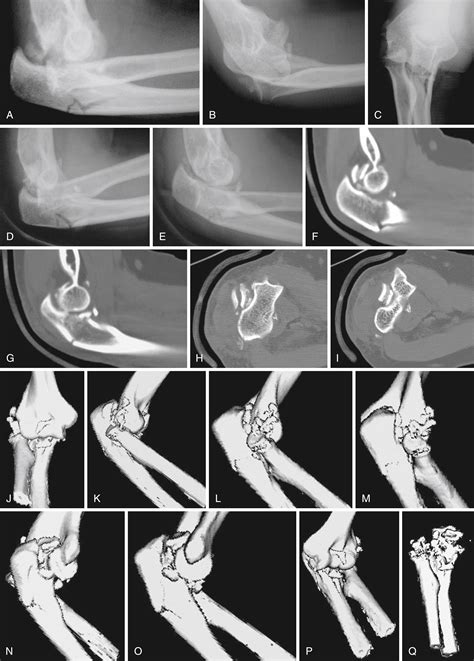 Fractures Of The Proximal Ulna Clinical Tree