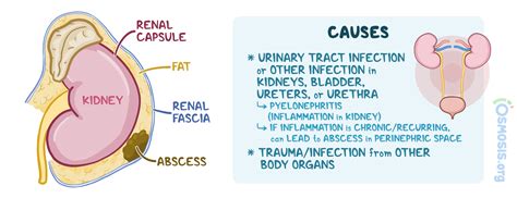 Perinephric Abscess What Is It Causes Diagnosis Treatment Osmosis